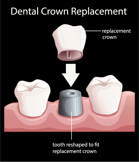 Dental Implant Crowns Houston TX | Solution For Missing Teeth